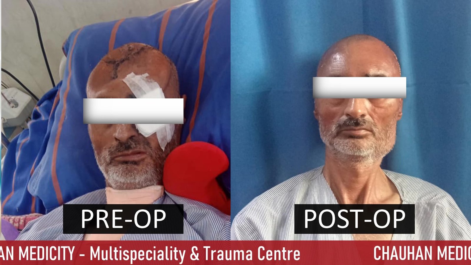Revolutionizing Recovery: 3D Mesh Cranioplasty - CHAUHAN MEDICITY